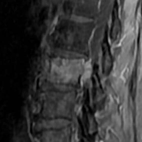 Spinal Instability Neoplastic Score (SINS) Calculator